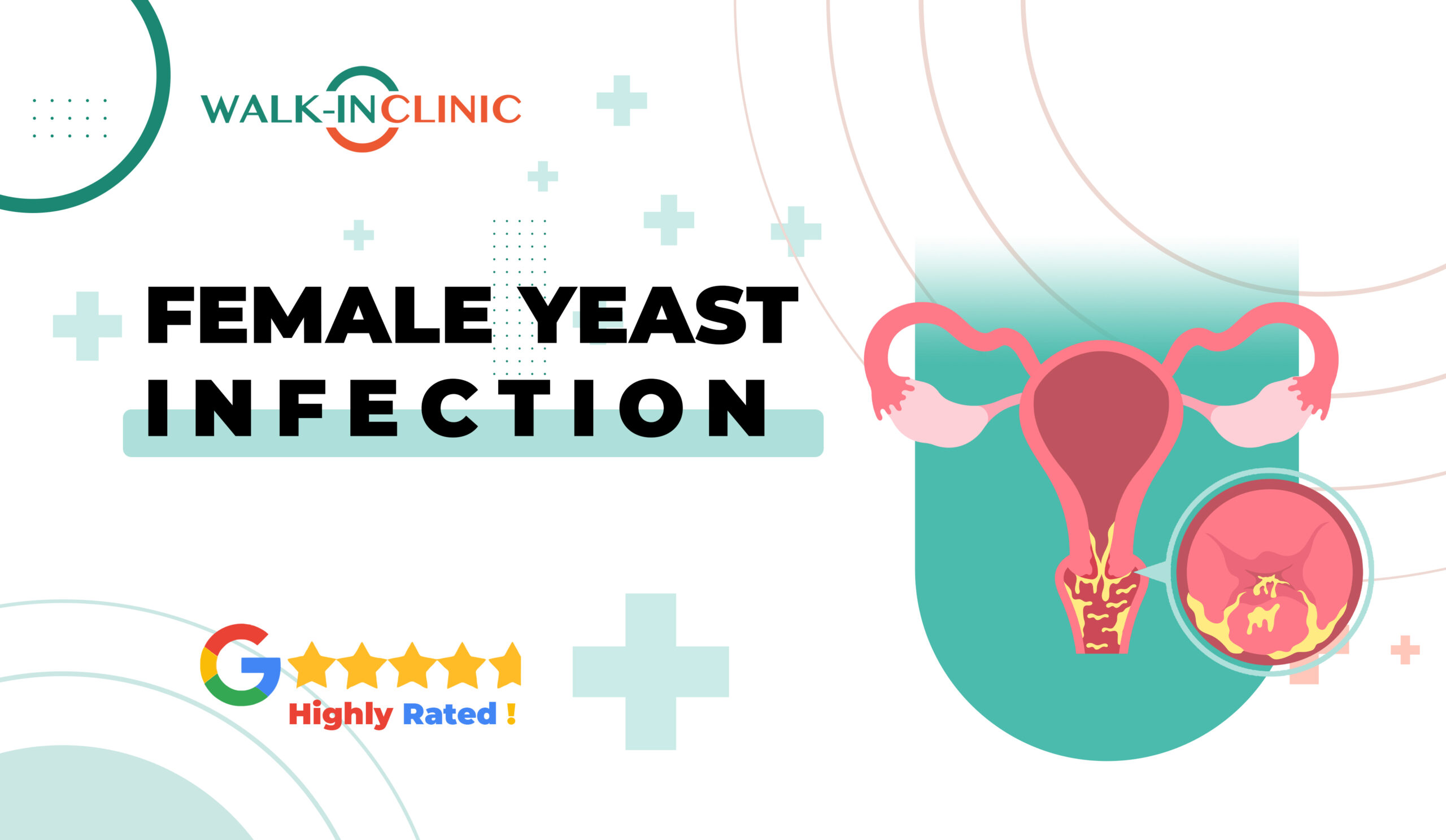 Yeast Infection | Diagnosis & Treatment