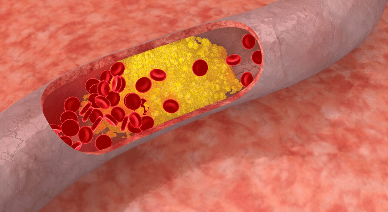 High Cholesterol Simple Steps for Better Management