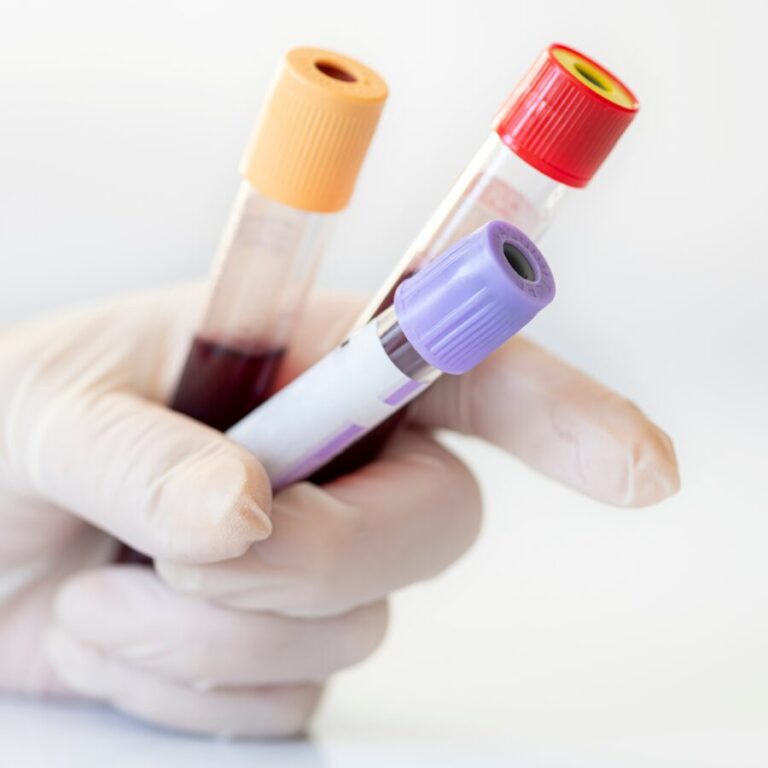 Inflammatory Markers Test London | Private Blood Test